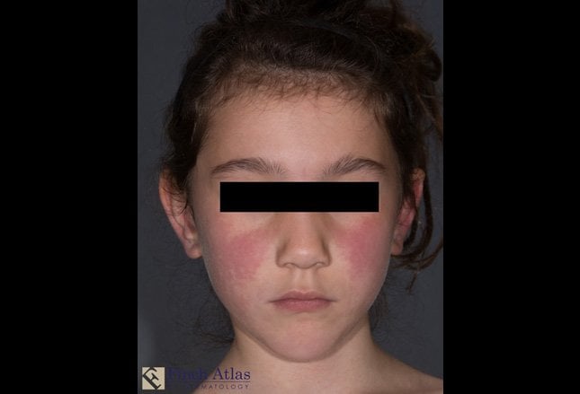 En images : comment identifier ces 12 éruptions cutanées