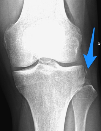 Cas clinique : traumatisme du genou chez une skieuse professionnelle