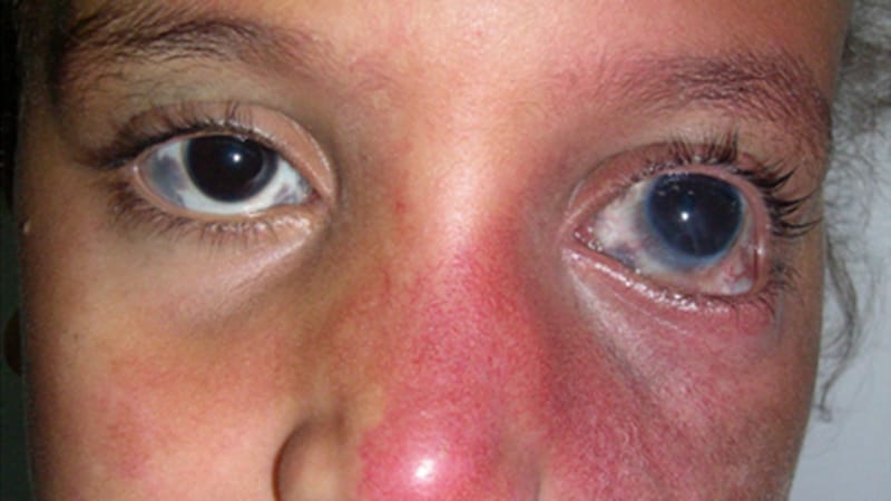 En images : comment identifier ces 12 éruptions cutanées