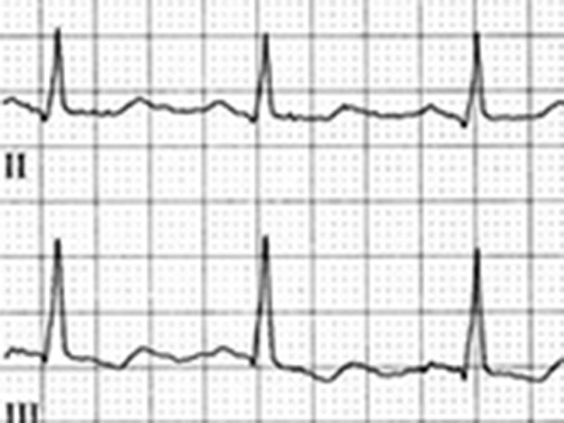 ECG : S’agit-il d’une inversion des électrodes