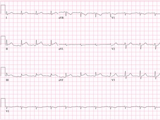Détecter un infarctus ST + avec un ECG réalisé à l’aide d’un smartphone