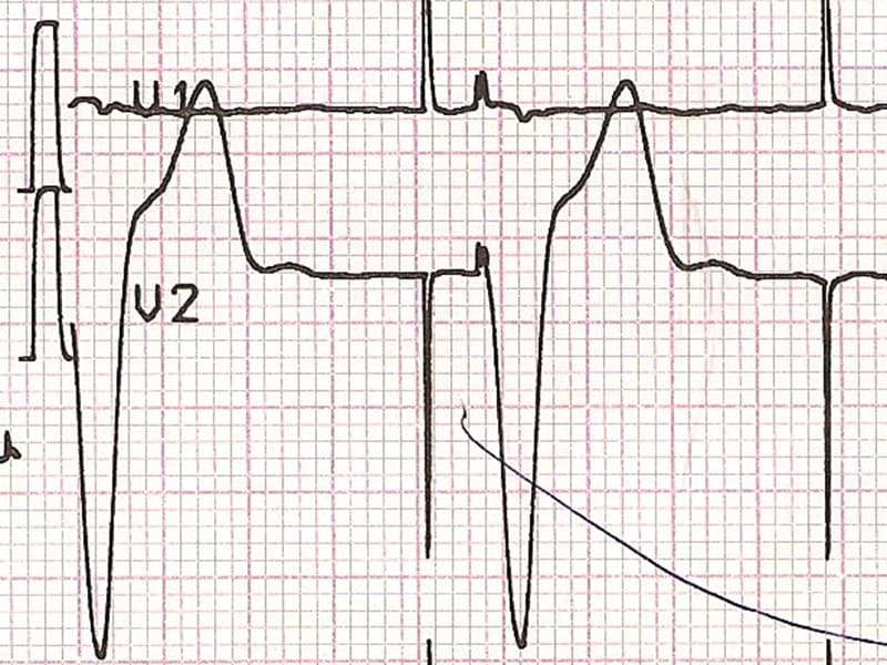 ECG: Que pensez-vous de ce rythme électro-entraîné?