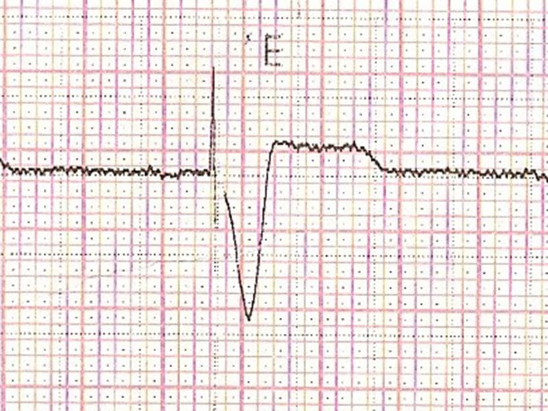 ECG : Pourquoi une pause ventriculaire après ce changement de pacemaker