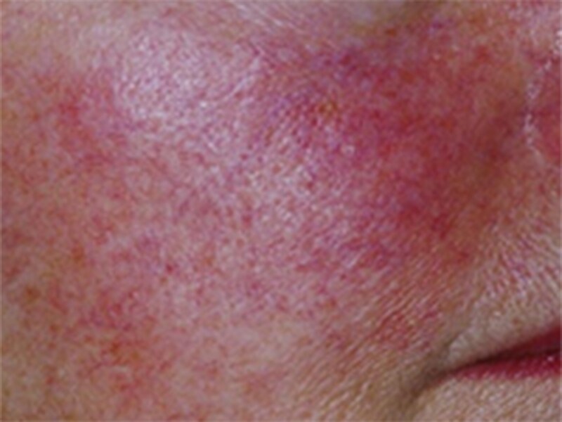 Rosacée : un signe précurseur de maladies neurologiques et viscérales