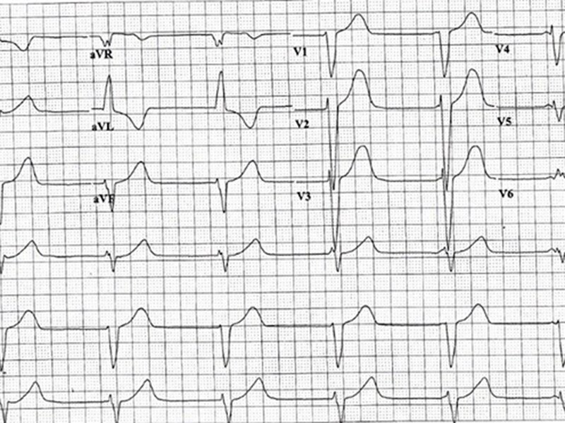 ECG : Quel est le rythme post-stent