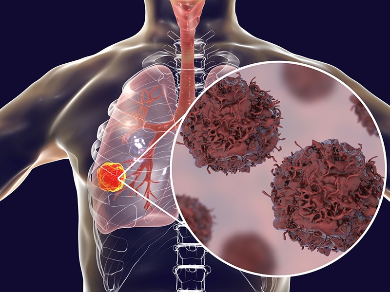 Augmentation de la survie globale dans le CPNC de stade III inopérable ...