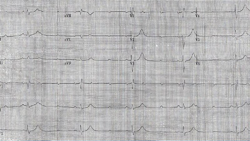 ECG : « J'ai l'impression de perdre connaissance » - Page 2