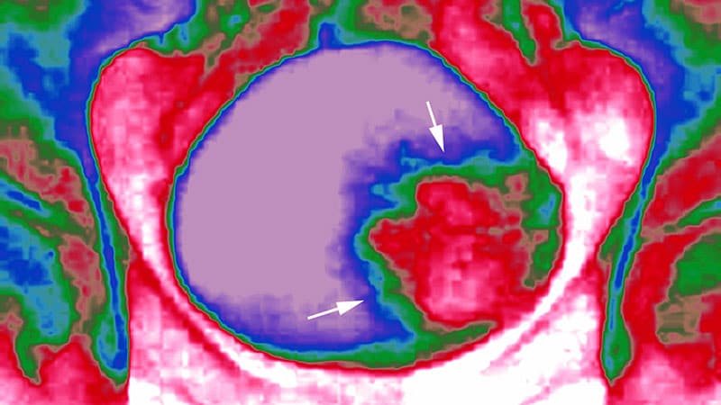 Cancer de la vessie : le point sur les arrêts de commercialisation et ...