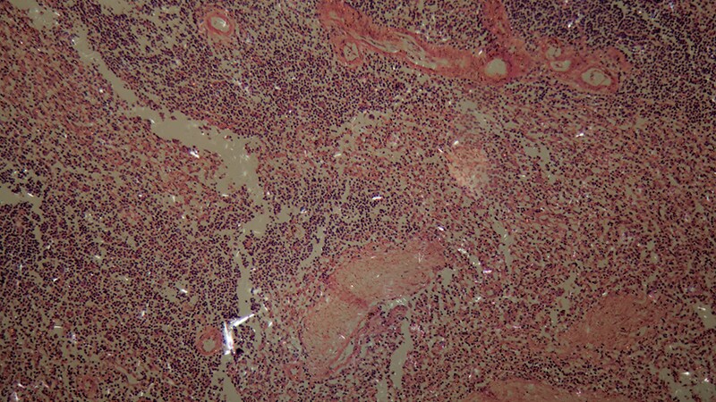 Récidive de cancer de l’ovaire: une deuxième chirurgie complète ...