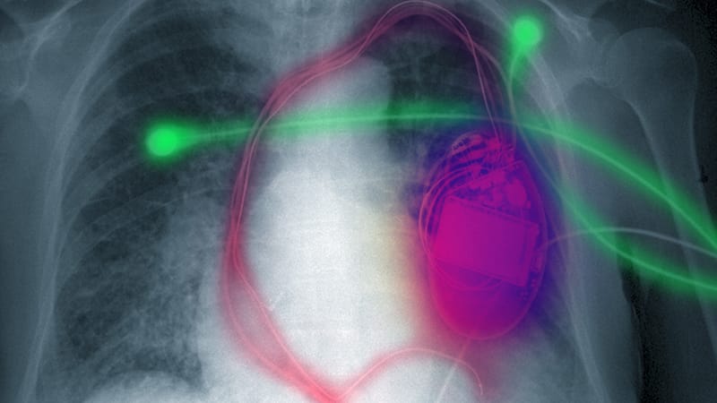 SCD-HeFT à 10 ans : nouvelles réflexions pour l’implantation d’un DAI ...