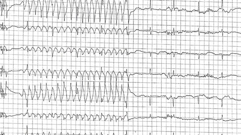 ECG : anomalie de télémétrie avant cholecystectomie