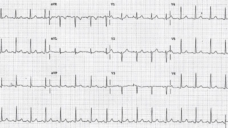 ECG : un tracé inquiétant chez un jeune athlète - Page 2
