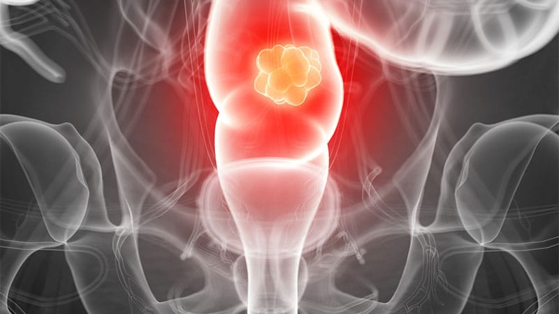 Cancer du rectum localement avancé : certains patients peuvent éviter ...