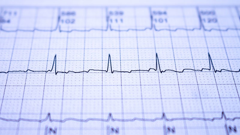 Fibrillation atriale infraclinique : l’anticoagulation sans bénéfice ...