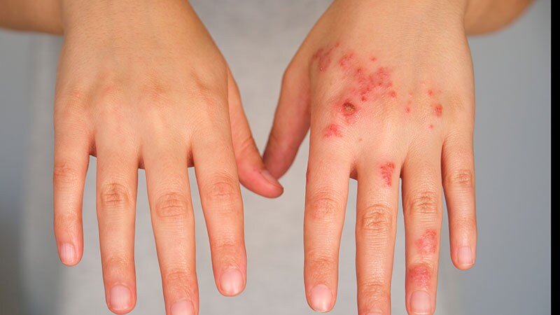 Lebrikizumab reçoit le feu vert de l’Europe pour le traitement de la ...