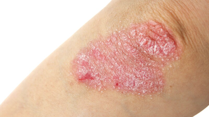 Psoriasis pustuleux généralisé : mise à disposition du spésolimab ...