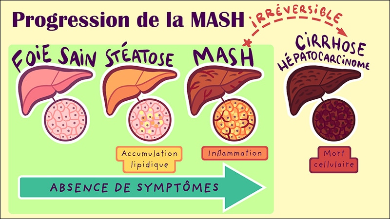 NASH/MASH : les nouvelles molécules devraient changer la donne