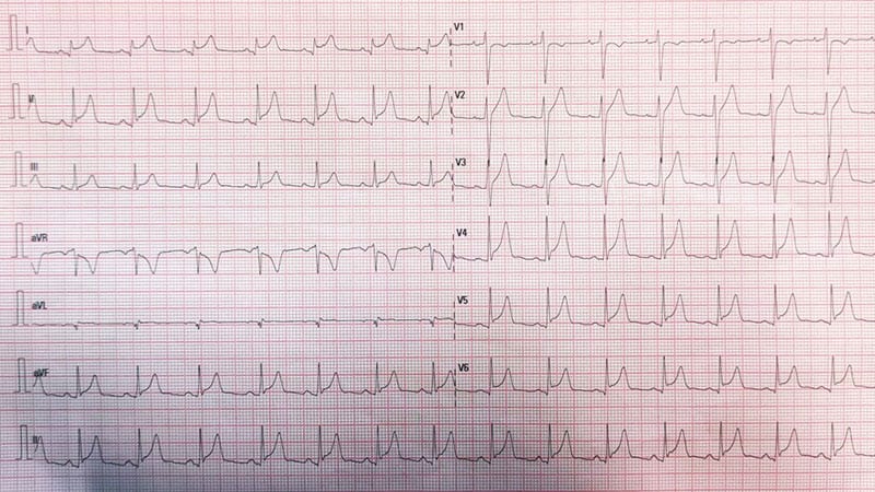 Cas clinique : douleur thoracique rétro-sternale constrictive chez un ...