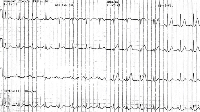 ECG : douleurs thoraciques chez une cinquantenaire