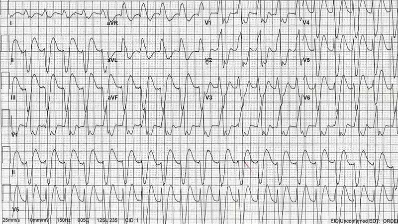 ECG : un quinquagénaire tachycarde