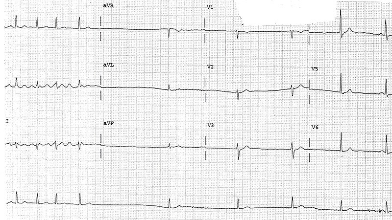 ECG : vertiges intermittents et présyncope - Page 2
