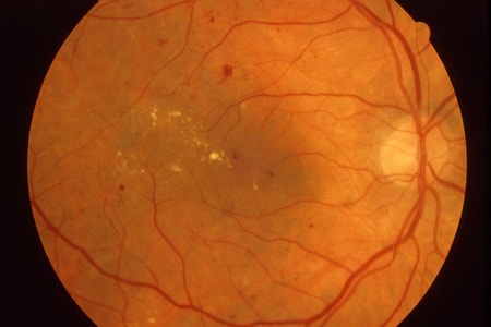 Clinical Management of Diabetic Retinopathy