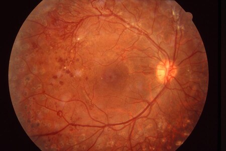 Clinical Management of Diabetic Retinopathy