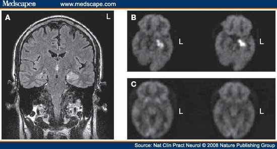 transient global amnesia medication