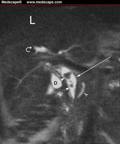 A 43-Year-Old Woman With a 7-Month History of Intermittent Abdominal...
