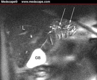 A 43-Year-Old Woman With a 7-Month History of Intermittent Abdominal...