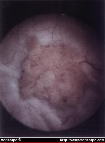 A Bladder Tumor in an 18-Year-Old Male