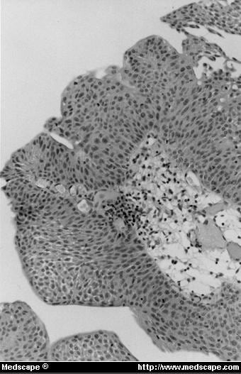 A Bladder Tumor in an 18-Year-Old Male