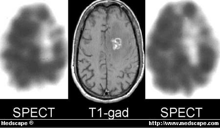 A 32-Year-Old AIDS Patient With New Onset Seizure - Page 2