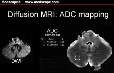 A 61-Year-Old Woman Unable to Walk