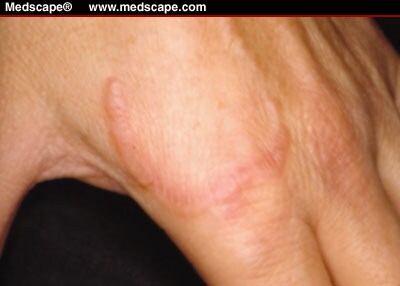 Reddish Brown Papules Forming A Ring-Like Lesion