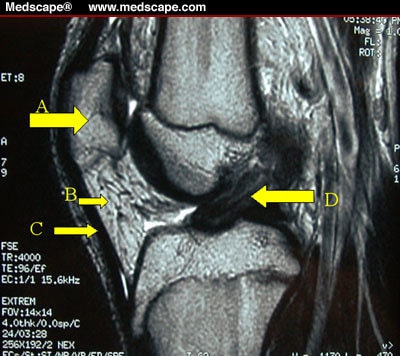 ACL Injuries, Part I