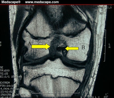 ACL Injuries, Part I