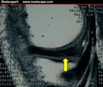 ACL Injuries, Part I