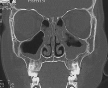 Sinus CT Scan
