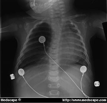 Chest Radiograph Showing Hyperexpanded Left Lung and Mediastinal Shift
