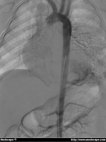 Abnormal Density at Left Lung Base