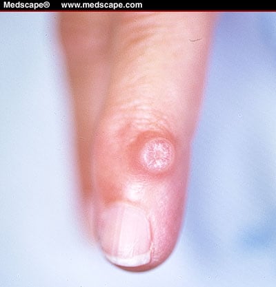 Bluish, Tender Nodule on the Finger