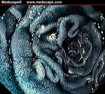 A Mosaic Pattern of the Descending Duodenum - Page 2