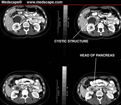An Unusual Cause of Right Upper Quadrant Pain in a Young Woman
