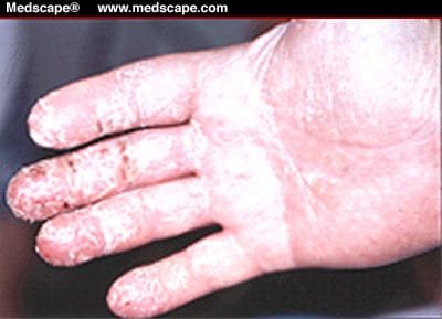 Fissuring Dermatitis on the Hands