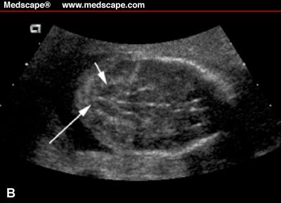 Banana Sign Ultrasound