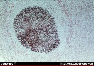 The Differential Diagnosis and Treatment of Vaginal Discharge With ...