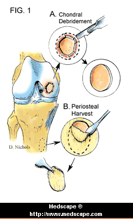 Treatment of Articular Cartilage Defects - Page 5