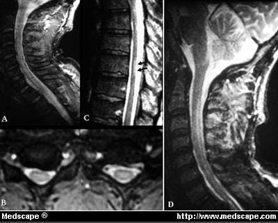 MRI in Spinal Cord Decompression Sickness - Page 2