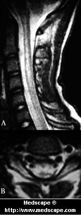 MRI in Spinal Cord Decompression Sickness - Page 2